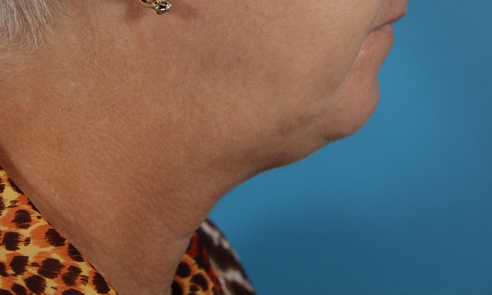 Chin Implant Before and After 02 | Dr. Ashlin Alexander