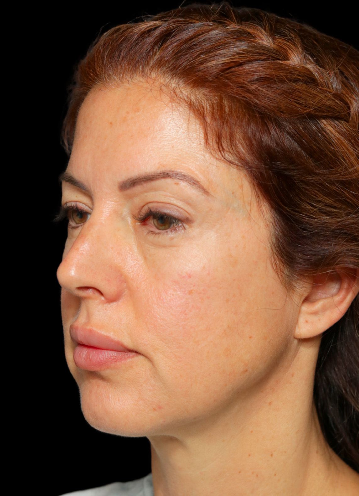 Face And Neck Lift Before and After 01 | Dr. Ashlin Alexander