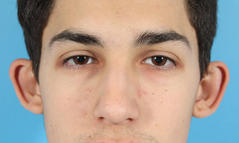 Otoplasty Before and After 02 | Dr. Ashlin Alexander