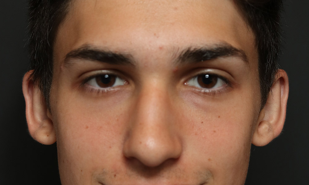 Otoplasty Before and After 02 | Dr. Ashlin Alexander