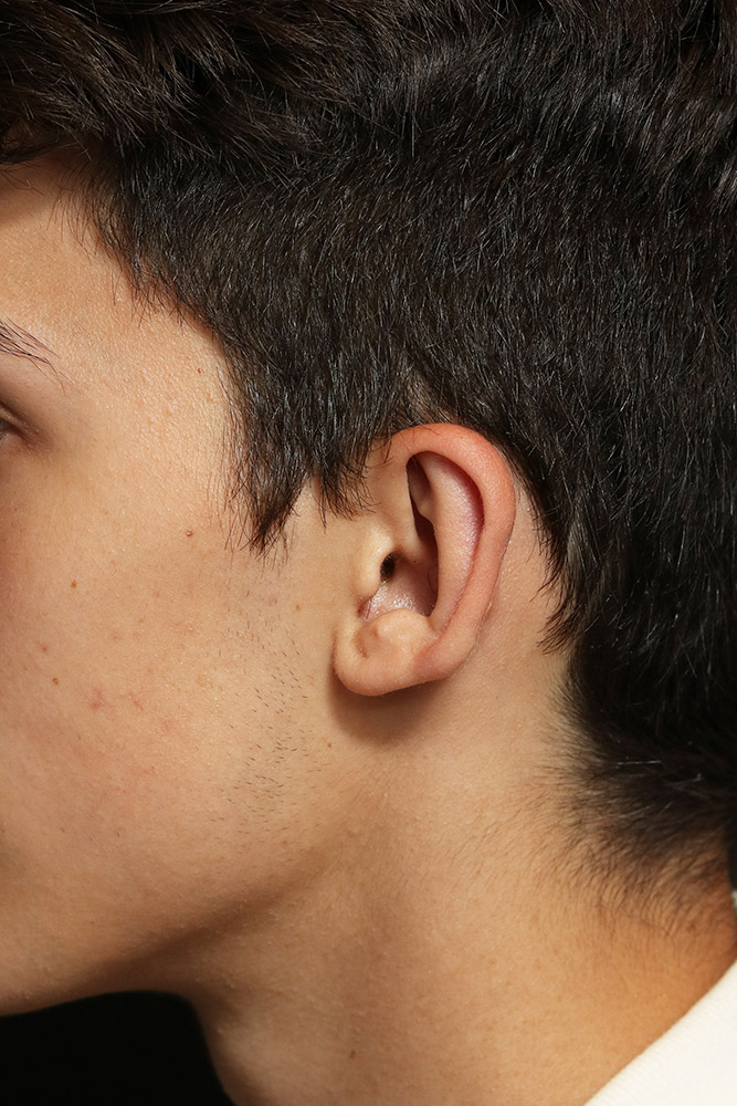 Otoplasty Before and After 02 | Dr. Ashlin Alexander