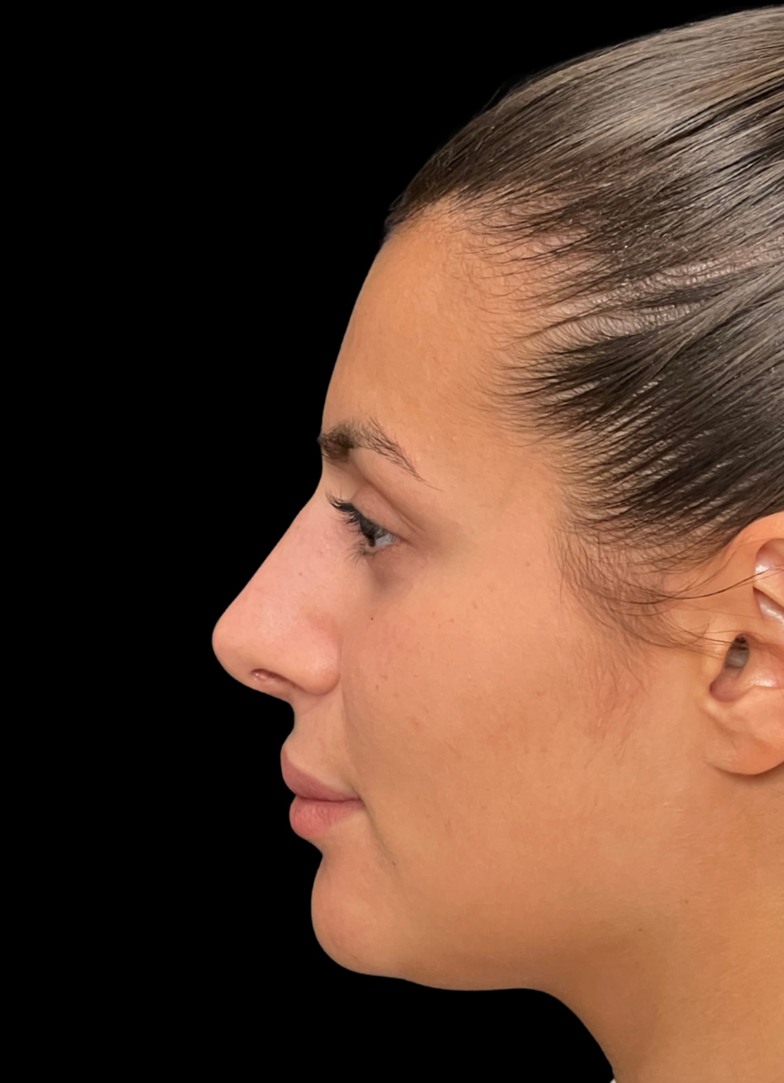 Rhinoplasty Before and After 01 | Dr. Ashlin Alexander