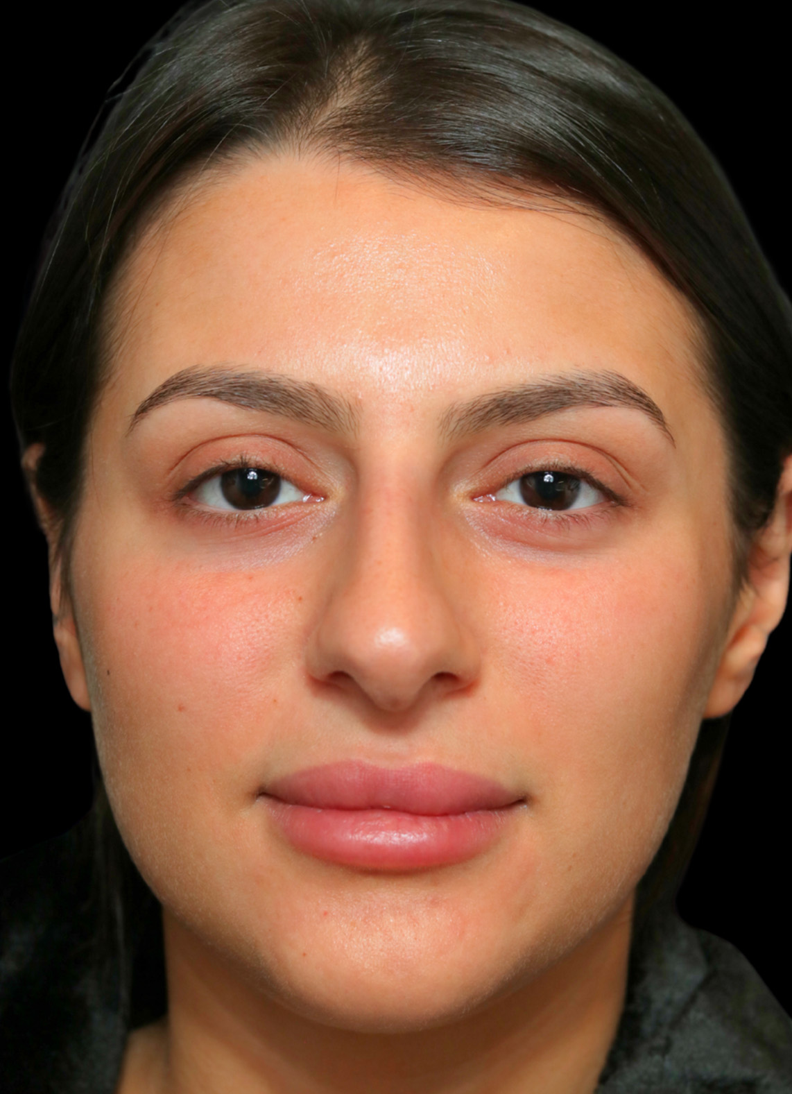 Rhinoplasty Before and After 01 | Dr. Ashlin Alexander