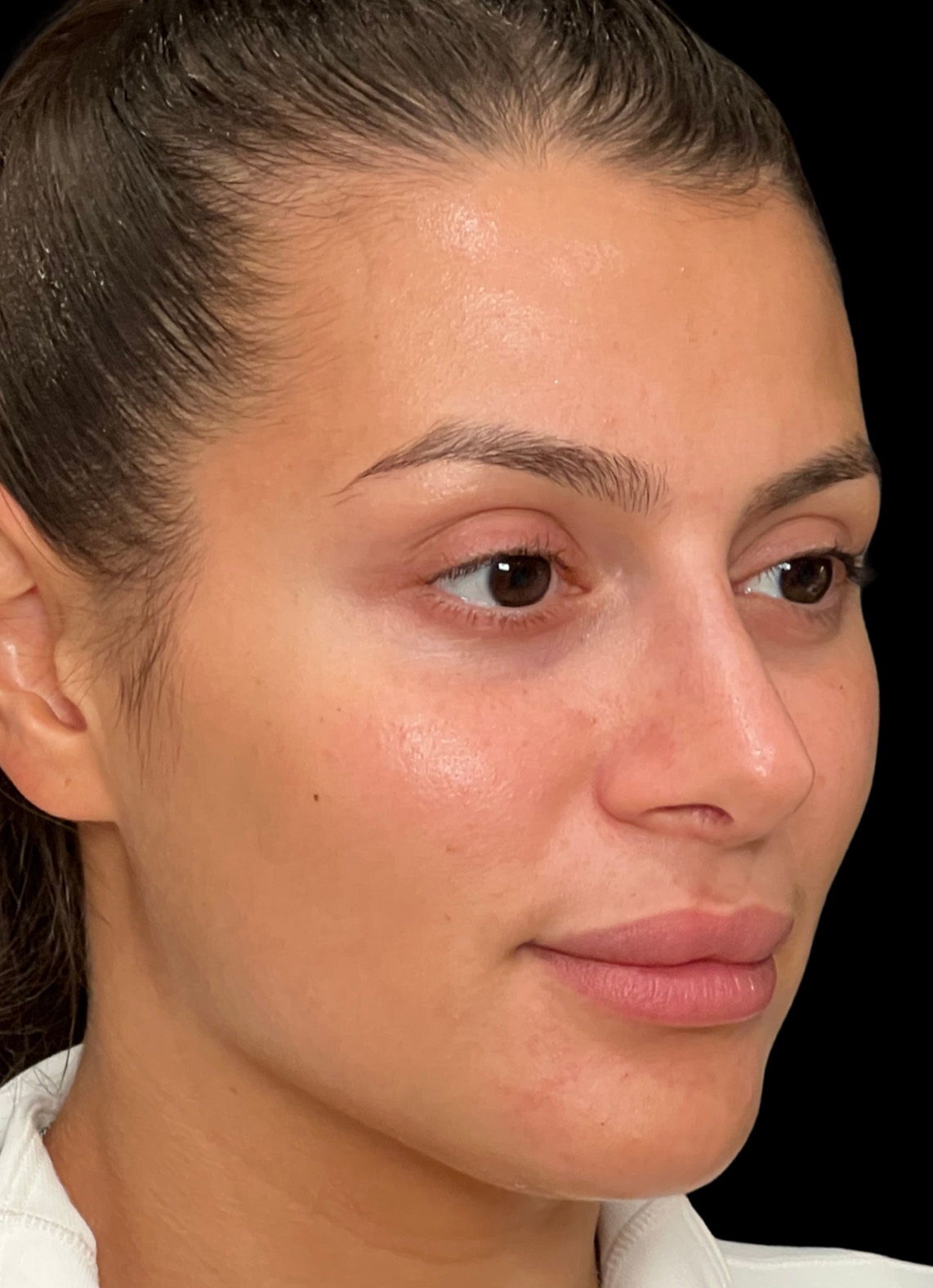 Rhinoplasty Before and After 01 | Dr. Ashlin Alexander