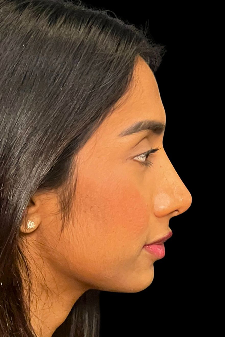 Rhinoplasty Before and After 02 | Dr. Ashlin Alexander