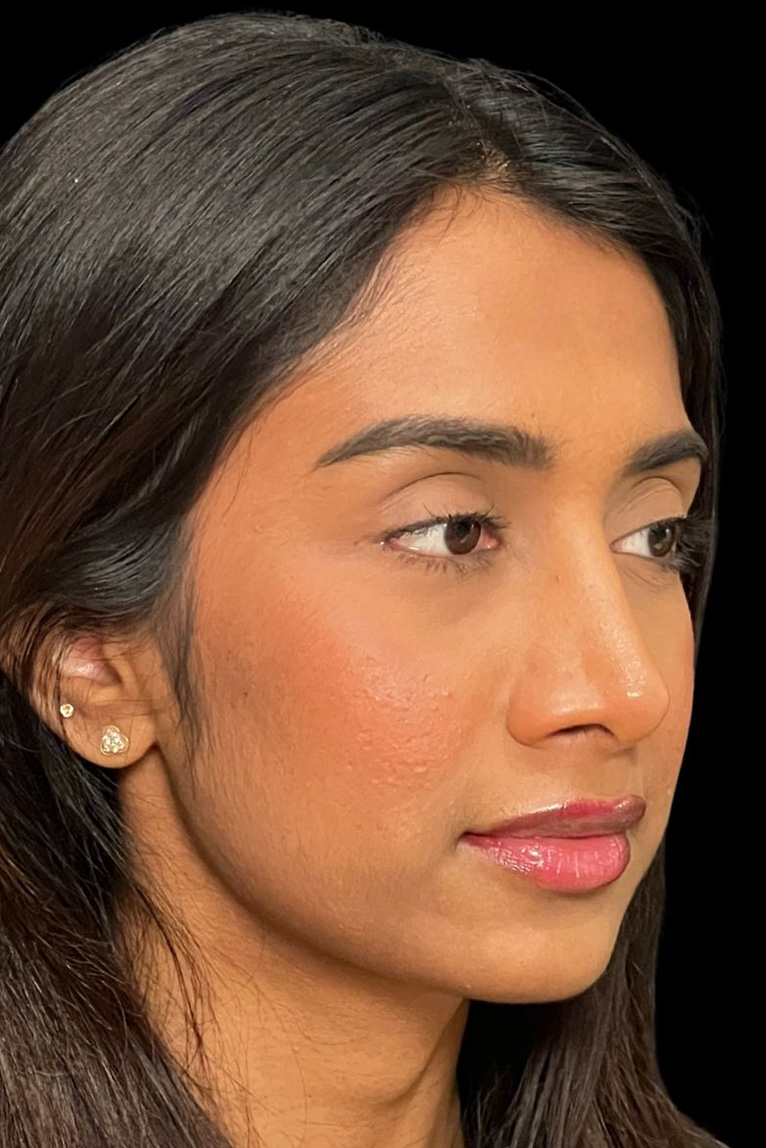 Rhinoplasty Before and After 02 | Dr. Ashlin Alexander