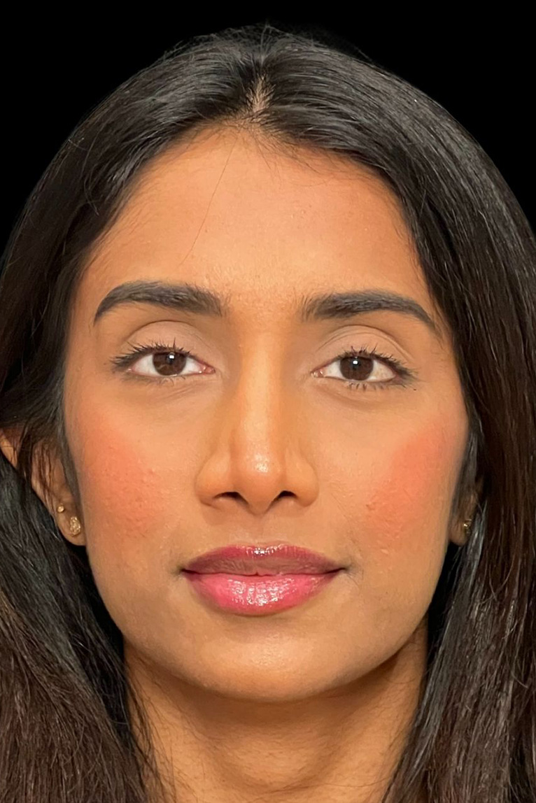 Rhinoplasty Before and After 02 | Dr. Ashlin Alexander