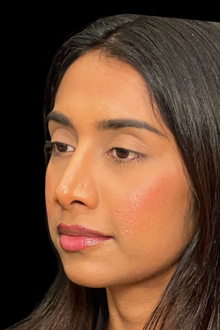 Rhinoplasty Before and After 02 | Dr. Ashlin Alexander