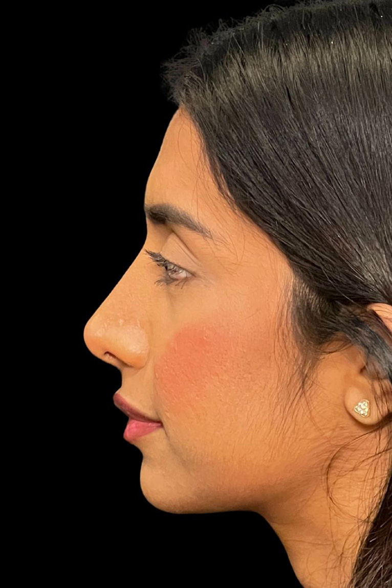 Rhinoplasty Before and After 02 | Dr. Ashlin Alexander