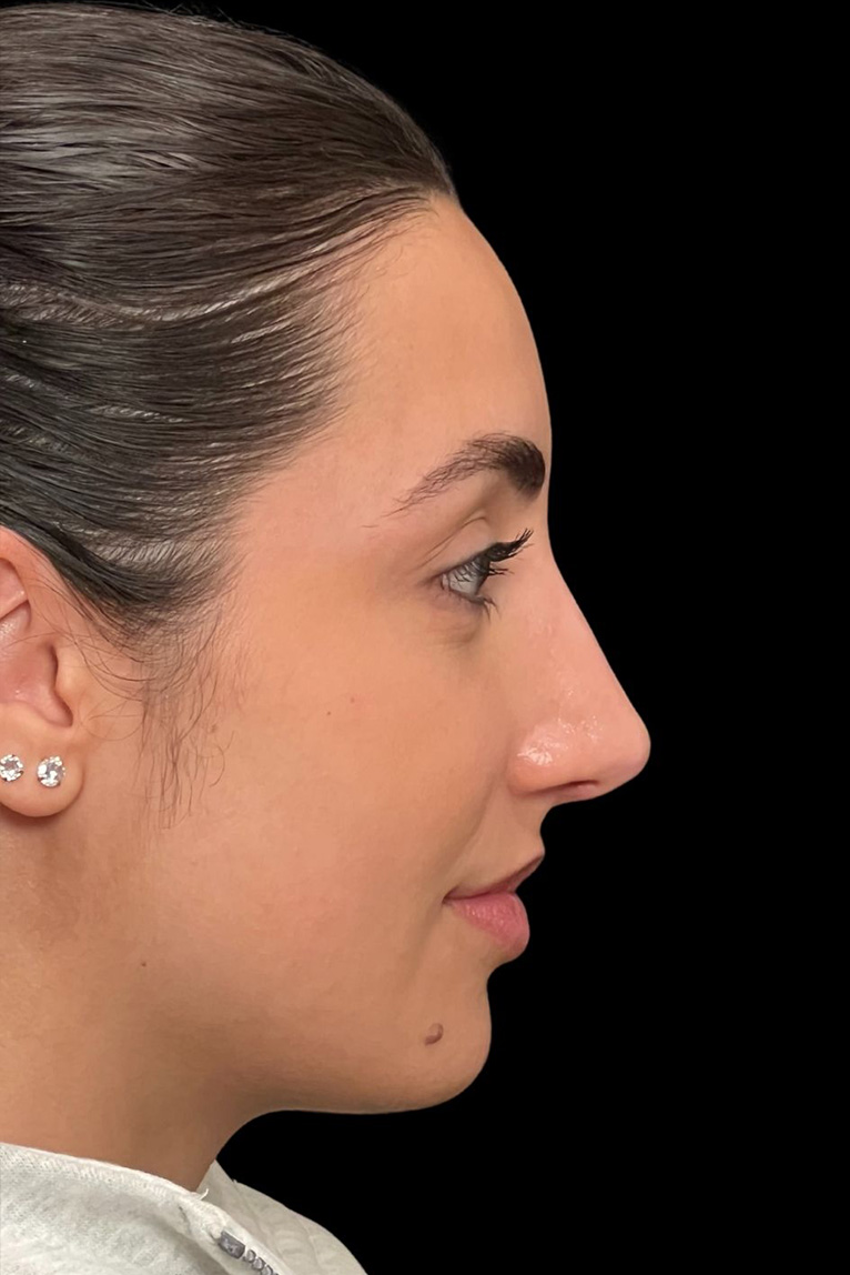 Rhinoplasty Before and After | Dr. Ashlin Alexander