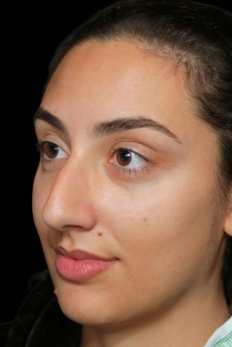 Rhinoplasty Before and After 03 | Dr. Ashlin Alexander