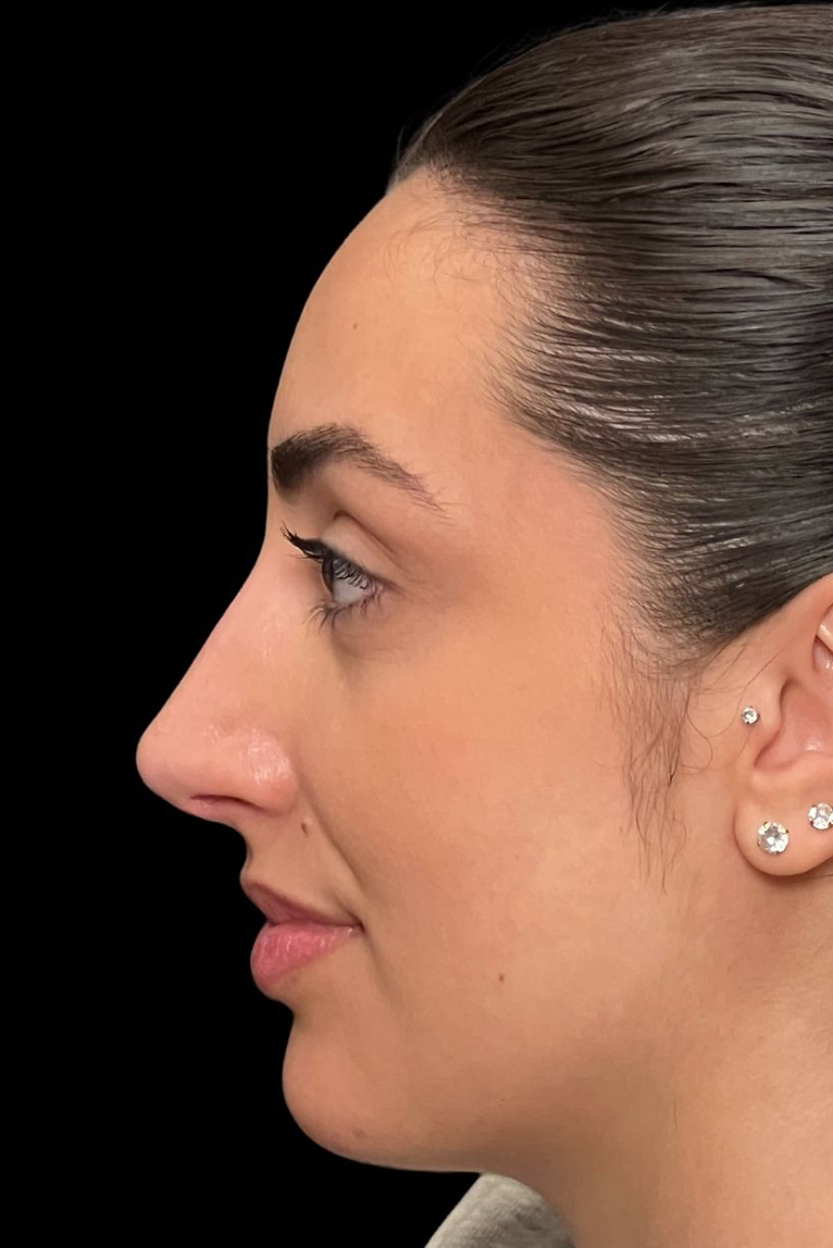 Rhinoplasty Before and After 03 | Dr. Ashlin Alexander