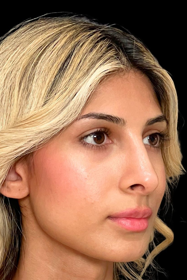 Rhinoplasty Before and After 04 | Dr. Ashlin Alexander