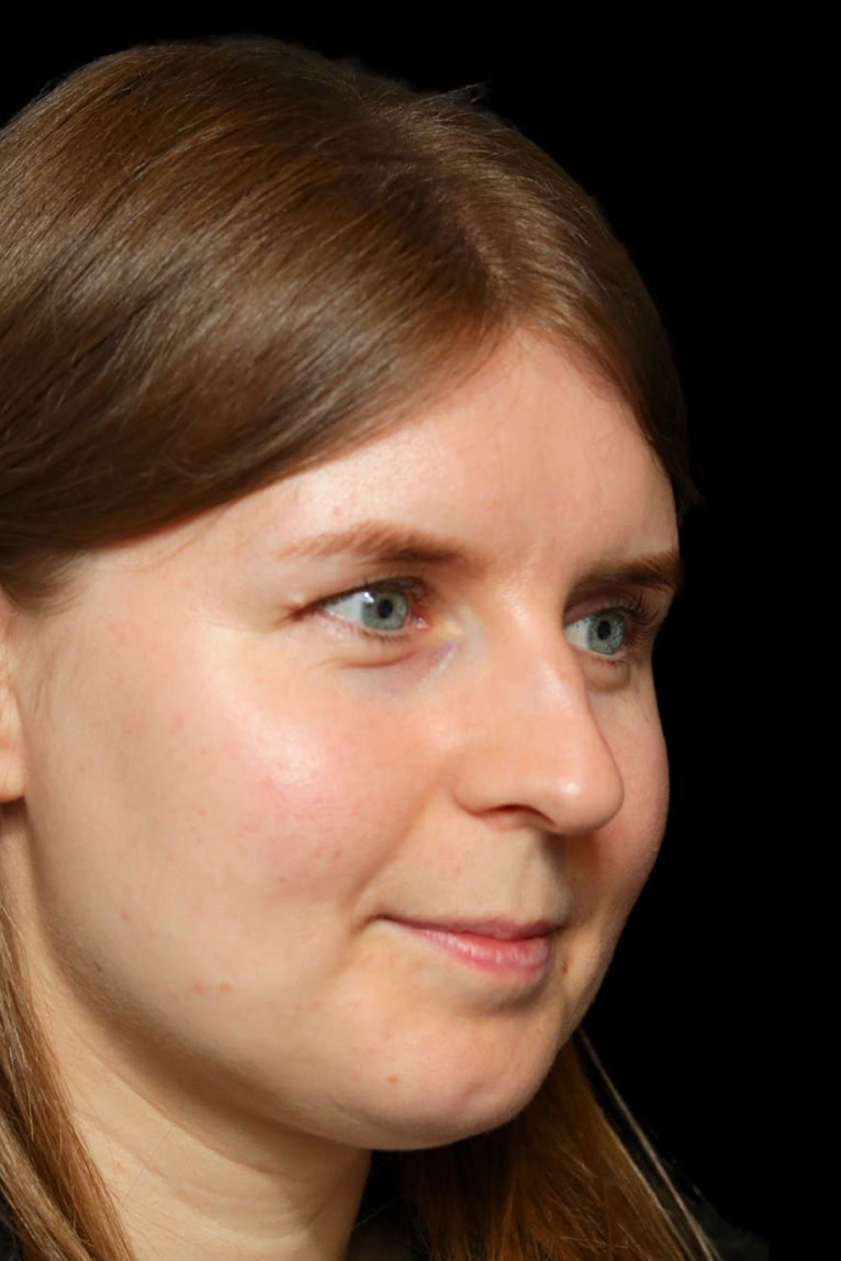 Rhinoplasty Before and After 05 | Dr. Ashlin Alexander