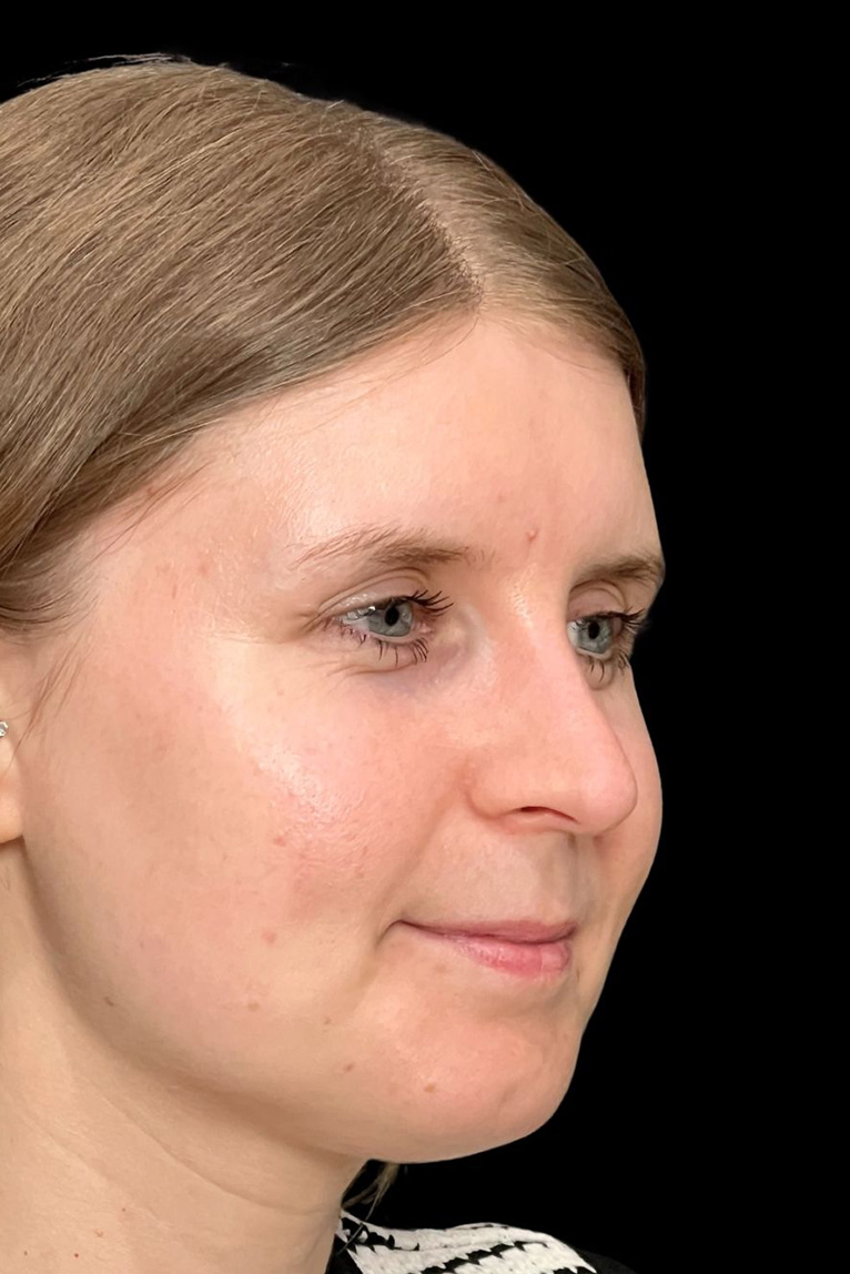 Rhinoplasty Before and After 05 | Dr. Ashlin Alexander