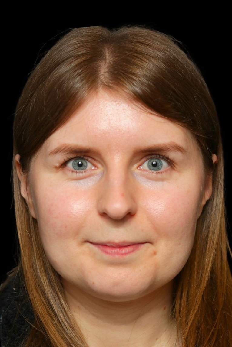 Rhinoplasty Before and After 05 | Dr. Ashlin Alexander