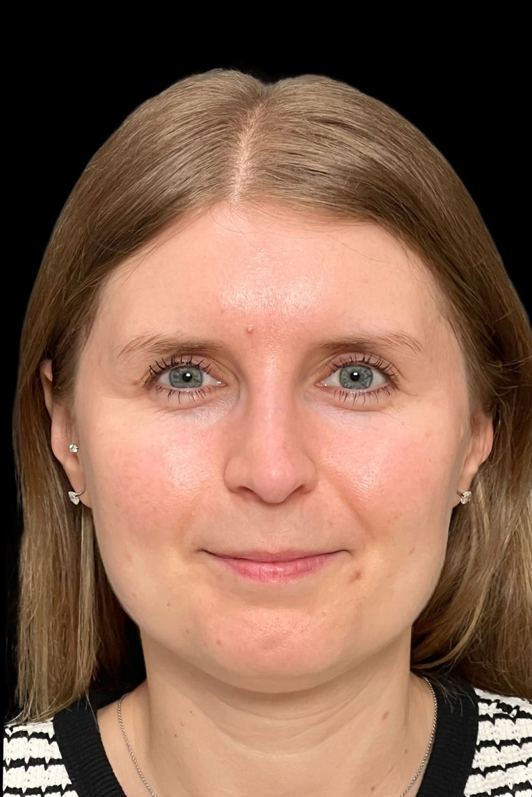 Rhinoplasty Before and After 05 | Dr. Ashlin Alexander