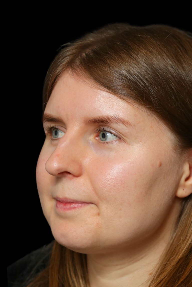 Rhinoplasty Before and After 05 | Dr. Ashlin Alexander