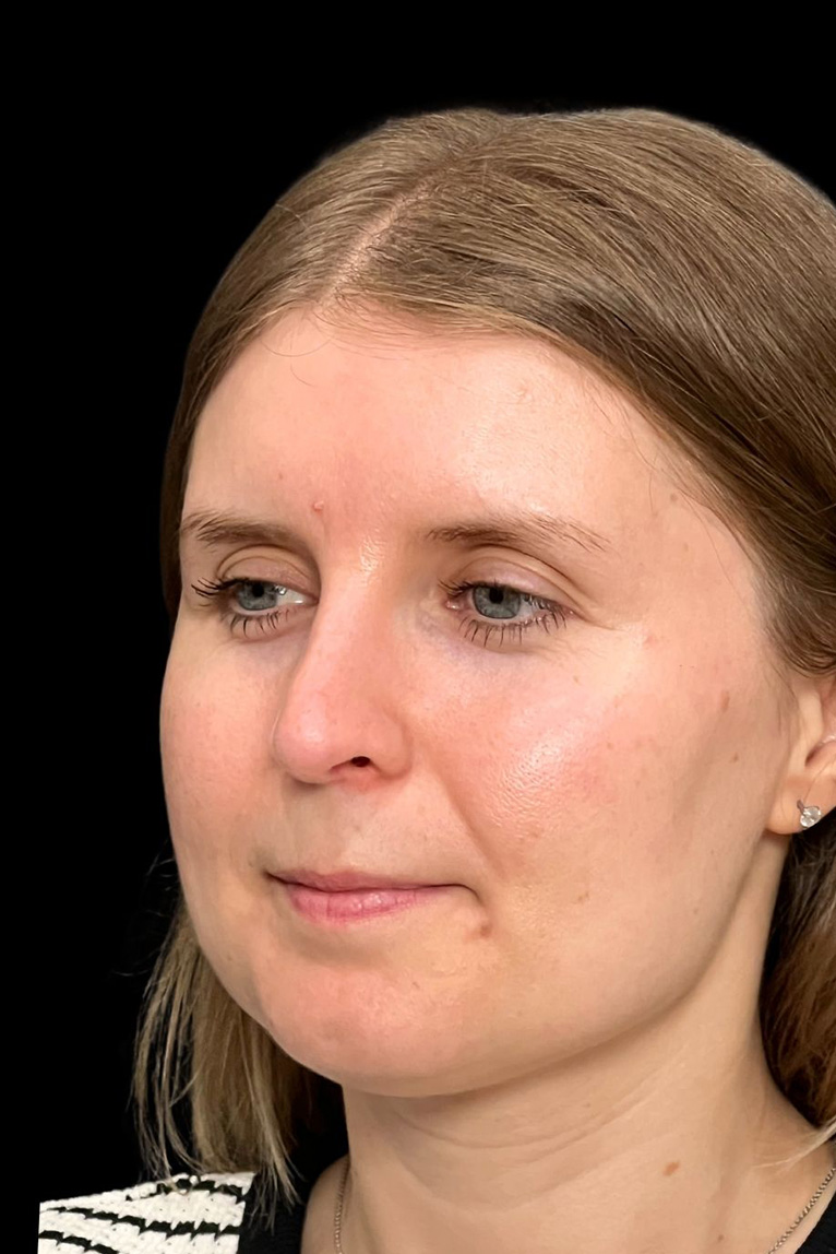 Rhinoplasty Before and After 05 | Dr. Ashlin Alexander