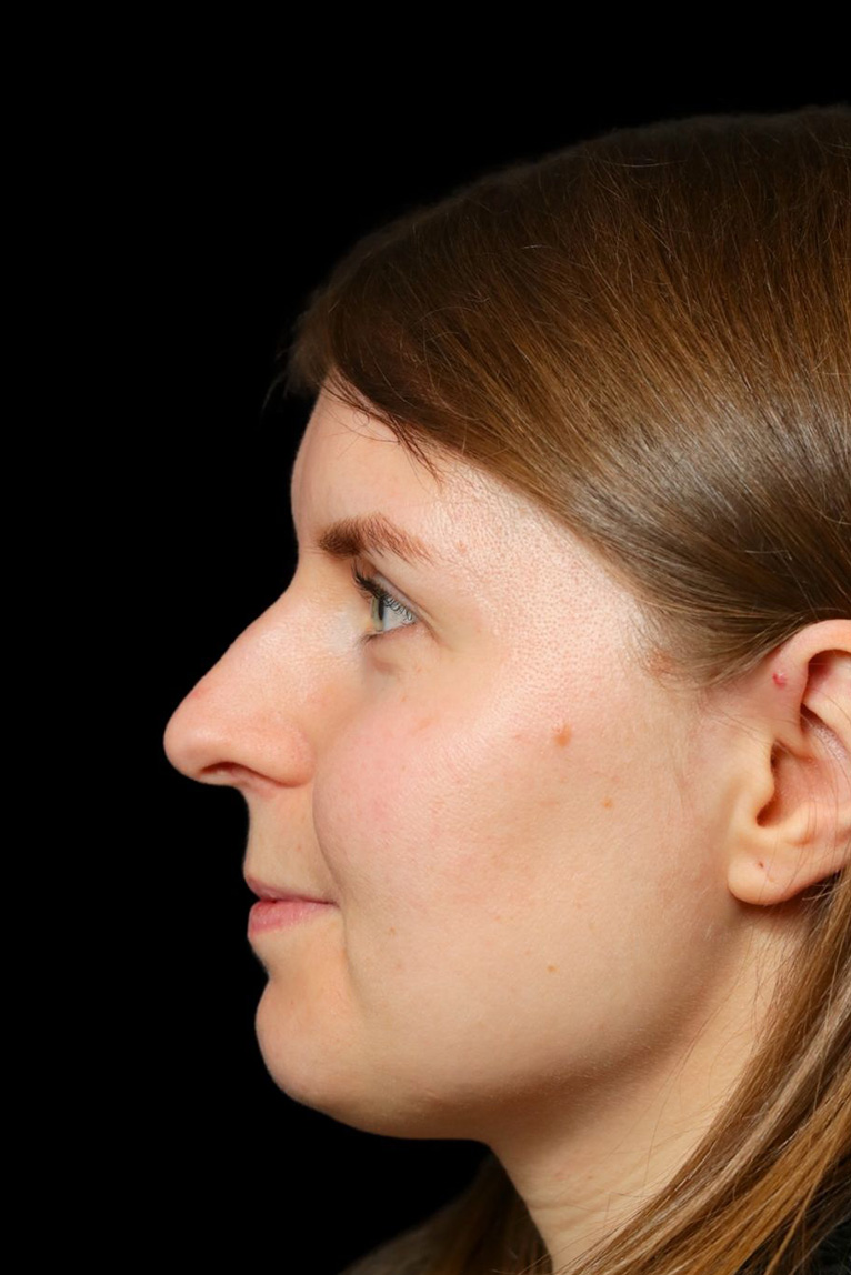 Rhinoplasty Before and After 05 | Dr. Ashlin Alexander