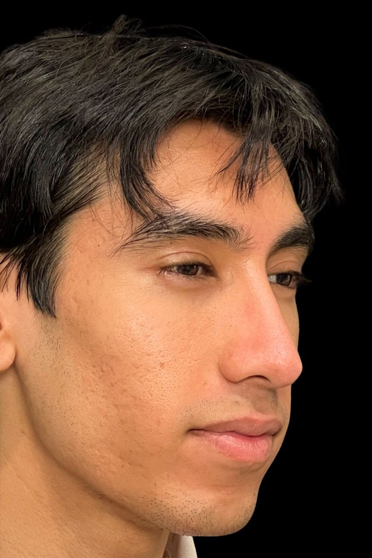 Rhinoplasty Before and After 06 | Dr. Ashlin Alexander