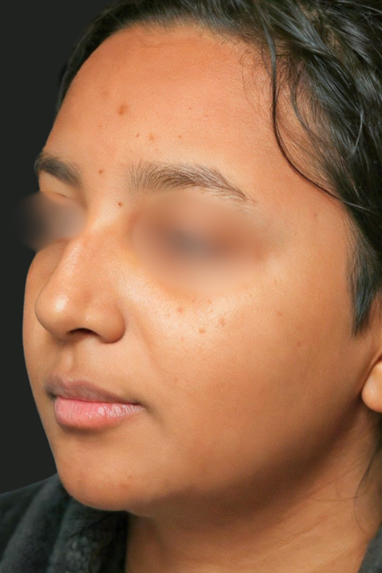 Rhinoplasty Before and After 08 | Dr. Ashlin Alexander