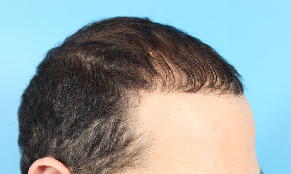 Hair Transplant Before and After 03 | Dr. Ashlin Alexander