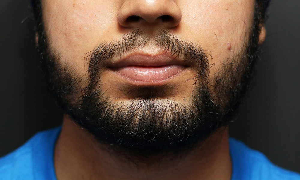 Hair Transplant Before and After | Dr. Ashlin Alexander