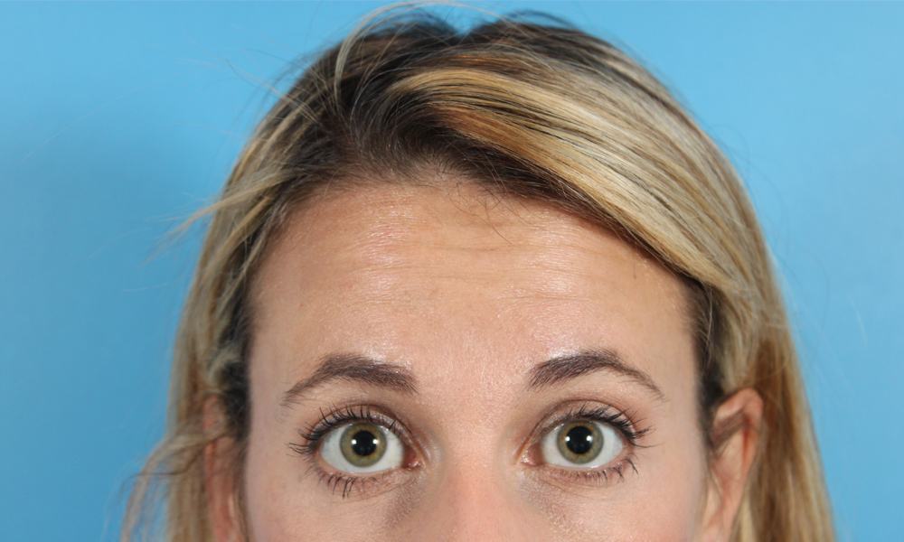 Botox Before and After 01 | Dr. Ashlin Alexander