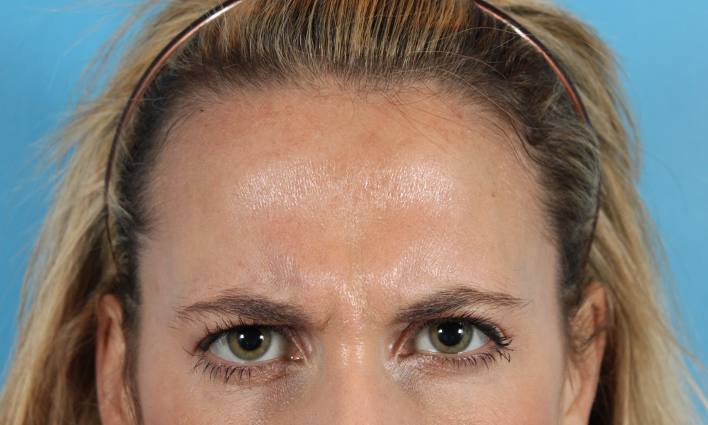 Botox Before and After 01 | Dr. Ashlin Alexander