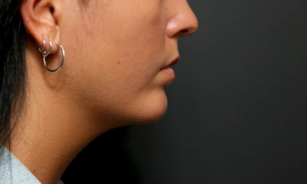 Chin Filler Before and After 01 | Dr. Ashlin Alexander