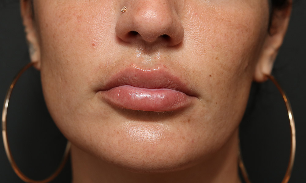 Lip Filler Before and After | Dr. Ashlin Alexander