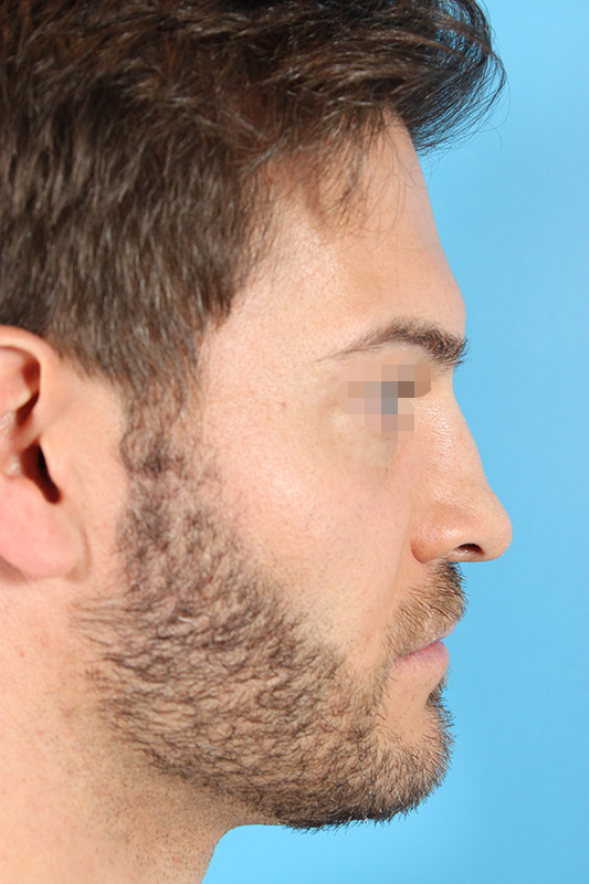 Non Surgical Rhinoplasty Before and After 02 | Dr. Ashlin Alexander