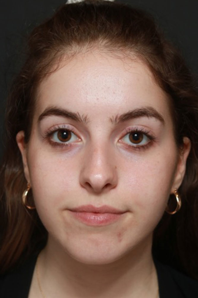 Non Surgical Rhinoplasty Before and After | Dr. Ashlin Alexander