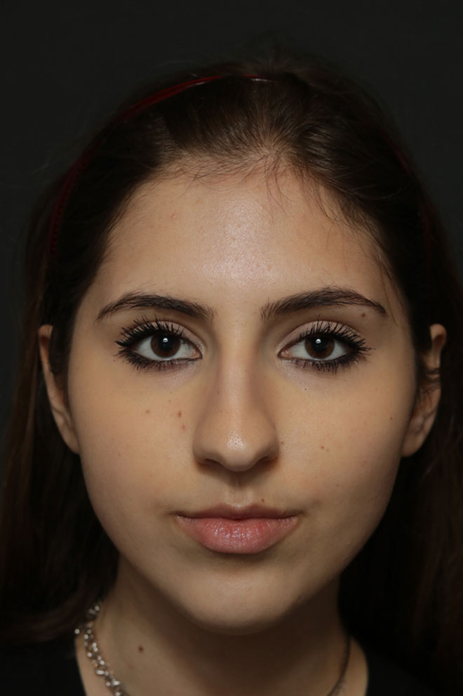 Non Surgical Rhinoplasty Before and After 10 | Dr. Ashlin Alexander