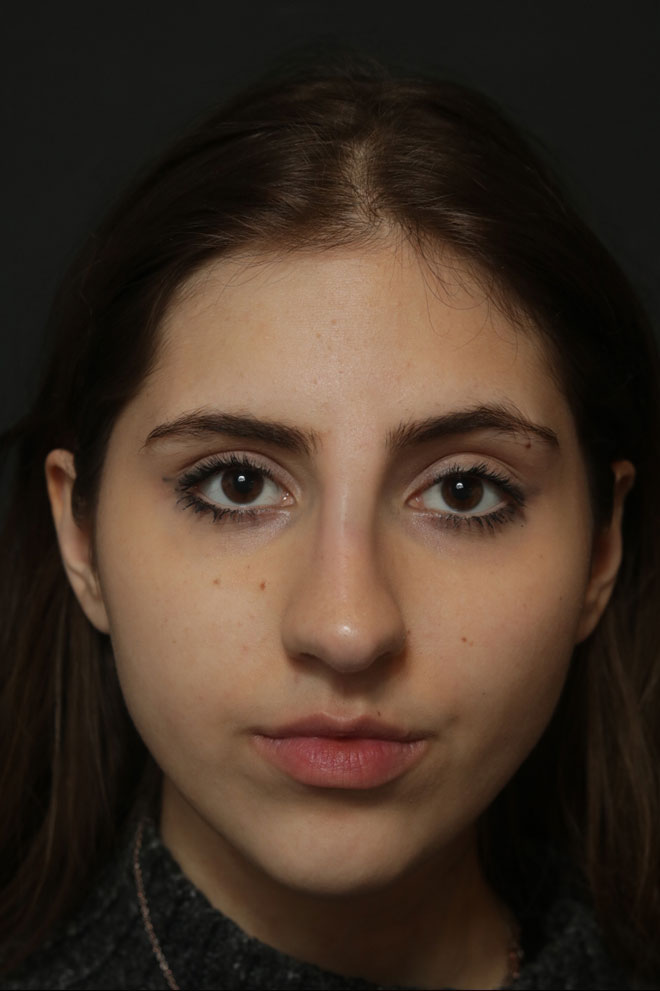 Non Surgical Rhinoplasty Before and After 10 | Dr. Ashlin Alexander