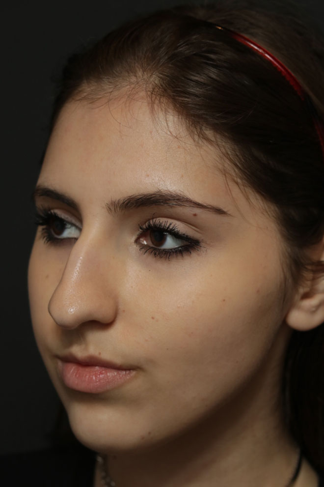 Non Surgical Rhinoplasty Before and After 10 | Dr. Ashlin Alexander