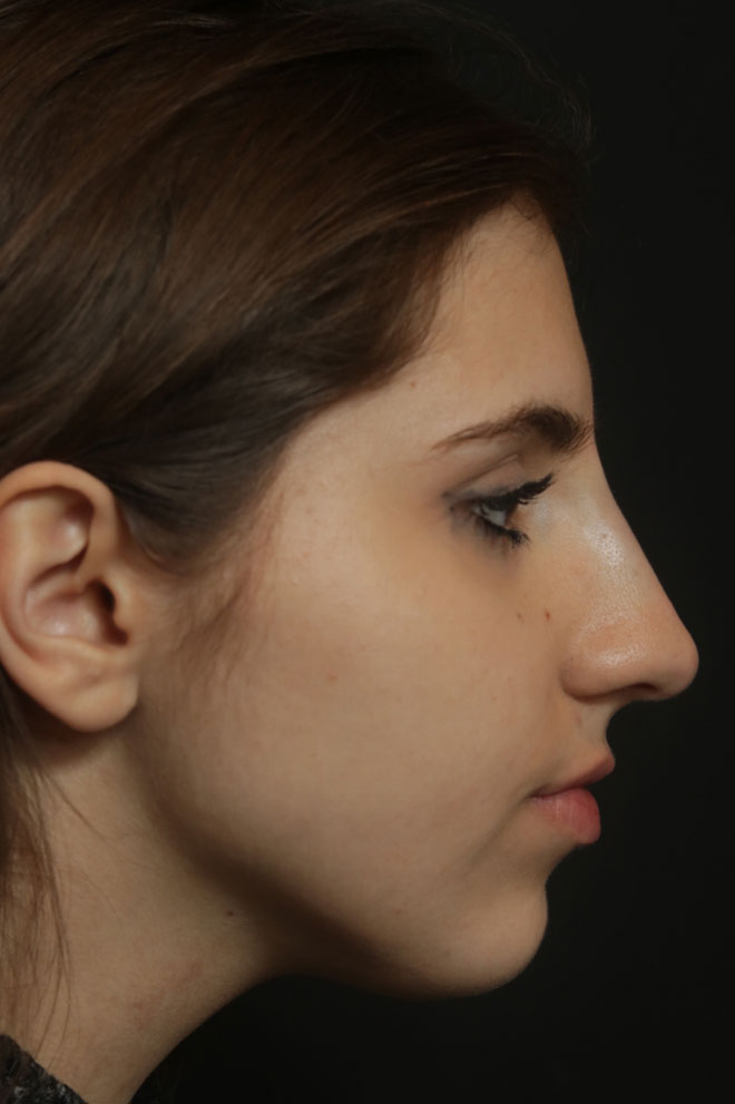 Non Surgical Rhinoplasty Before and After 10 | Dr. Ashlin Alexander