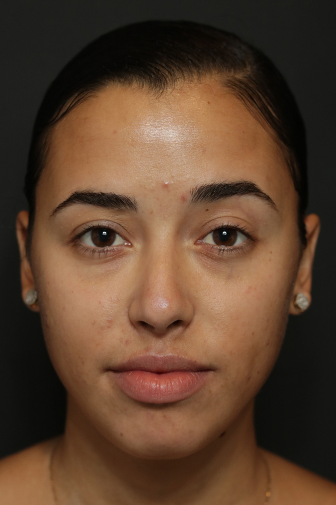 Non Surgical Rhinoplasty Before and After | Dr. Ashlin Alexander
