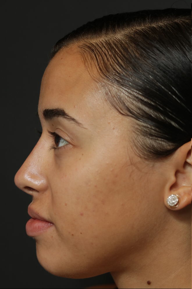 Non Surgical Rhinoplasty Before and After 11 | Dr. Ashlin Alexander
