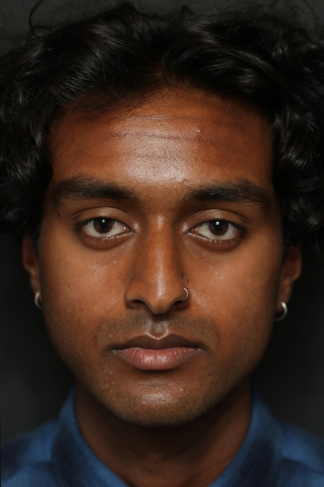 Non Surgical Rhinoplasty Before and After | Dr. Ashlin Alexander