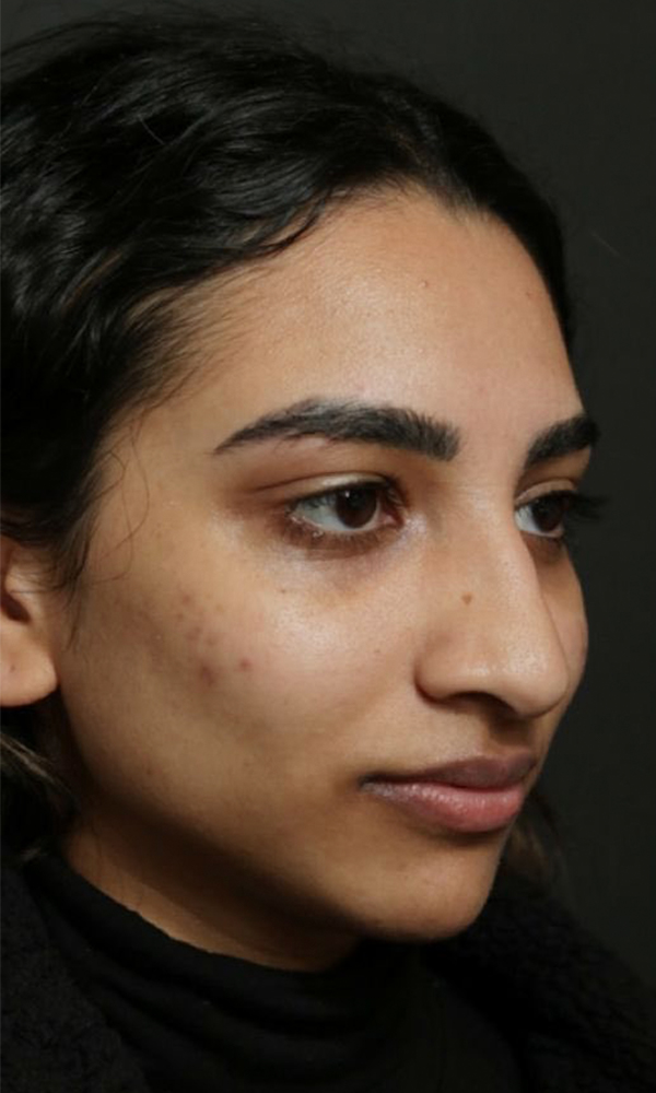 Non Surgical Rhinoplasty Before and After 13 | Dr. Ashlin Alexander